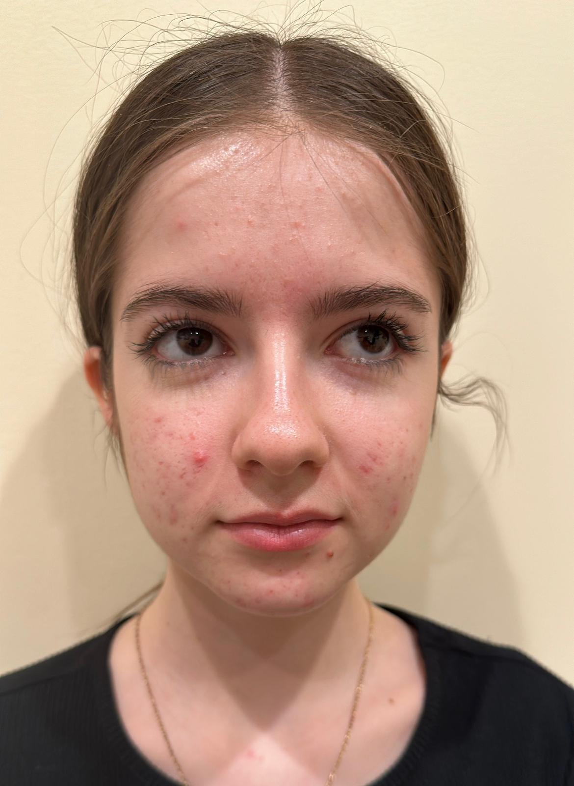 Best Microneedling Treatments in Edmonton | Oxyderm