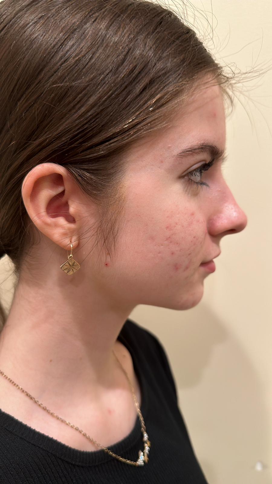 Best Microneedling Treatments in Edmonton | Oxyderm