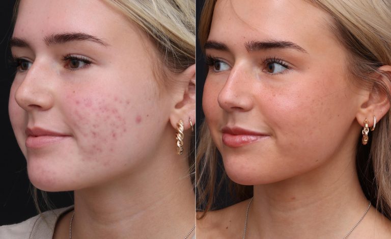 Scar Treatment Near Me – Expert Care at Oxyderm Edmonton - (780) 863-7561